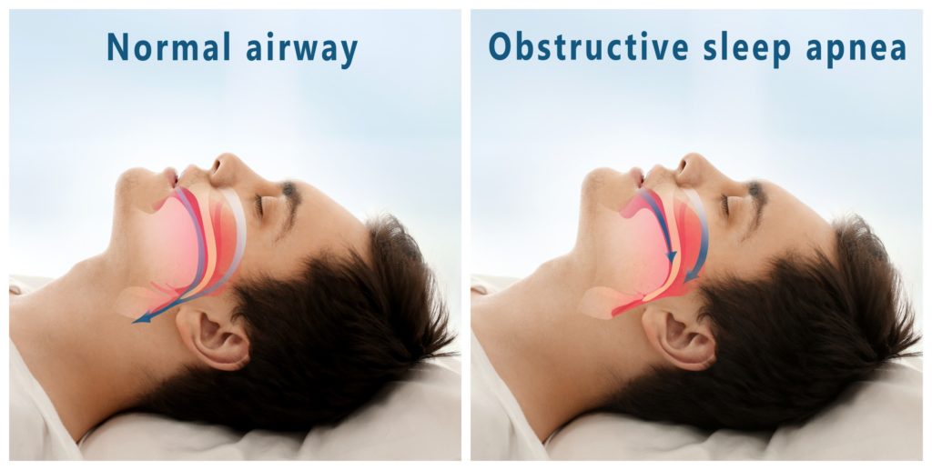 Maintain Your Oxygen With Sleep Apnea In Southlake Enclave Dental maintain-your-oxygen-with-sleep-apnea-in-southlake-enclave-dental